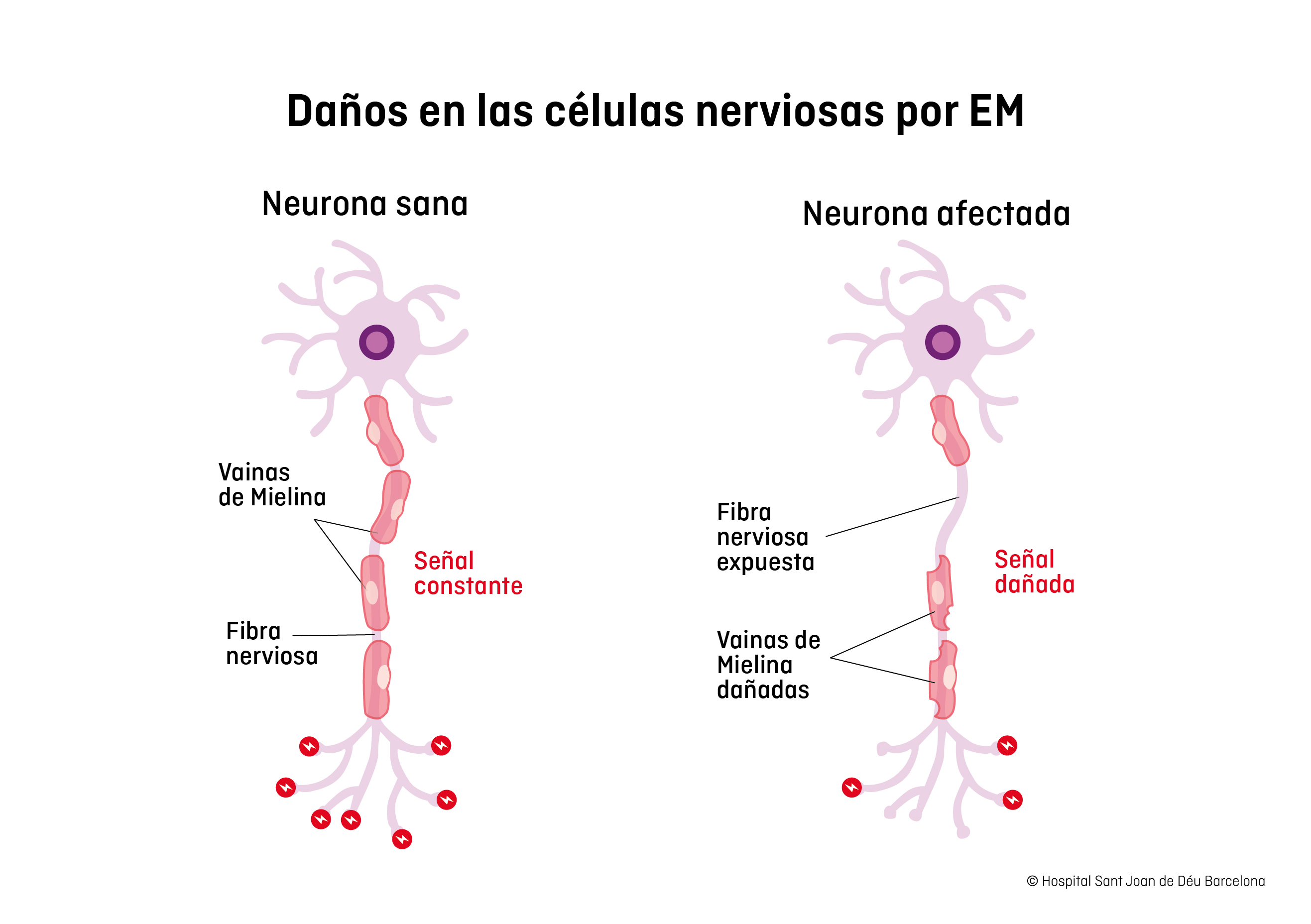Esclerosis múltiple | Escola Salut SJD